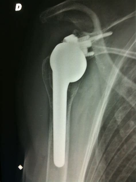 Chirurgie De L Epaule Operation Tendinite Epaule