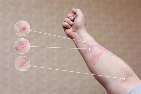 Psoriazisul Cauze simptome și opțiuni de tratament Centrul Medical