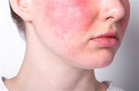 Strese Bağlı Cilt Hastalıkları Nelerdir Saç Bakım Güzellik
