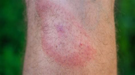 Borelioza Z Lyme Choroba Odkleszczowa Zdrowe Dziecko