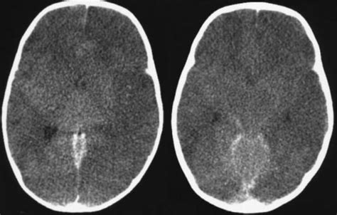 Edema cerebral causas síntomas y tratamiento