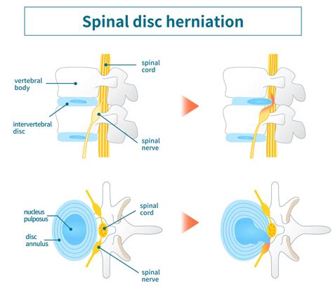 Herniated Discs Jacksonville Orthopaedic Institute