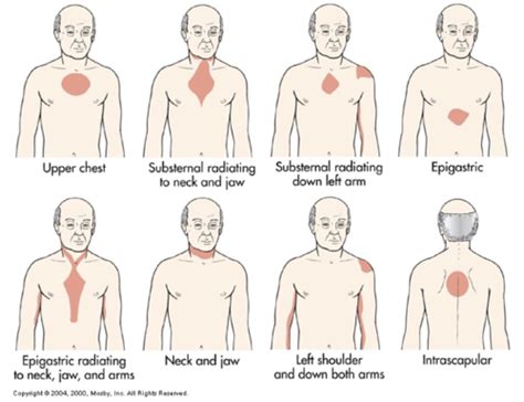 390 CAD And Acute Coronary Syndrome Exam 1 Flashcards Quizlet