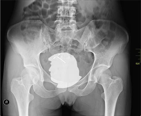 An Orifice By Orifice Census Of The Objects Us Emergency Room Doctors Removed From Their