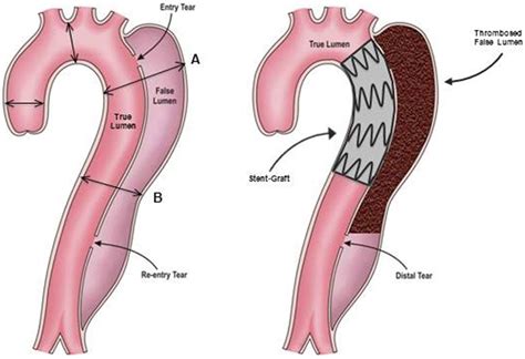 Endovascular Repair Of Type B Aortic Dissection Circulation