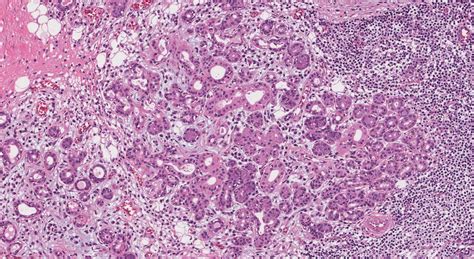 Sialodenitis Atlas Of Pathology