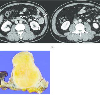 A 73 Year Old Man With Rectal Gastrointestinal Stromal Tumor GIST