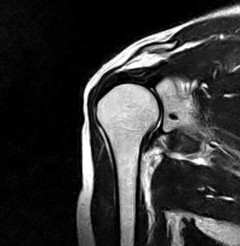 Shoulder Mri Scan Medserena Open Mri Hot Sex Picture