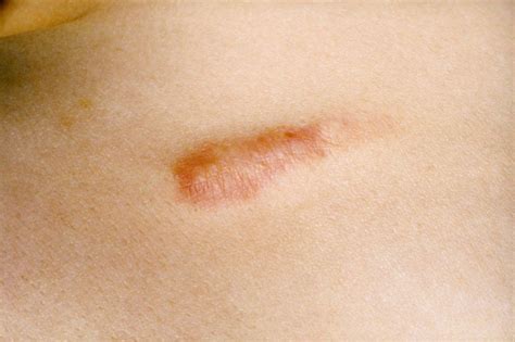 Keloid Kenali Gejala Dan Cara Menghilangkannya