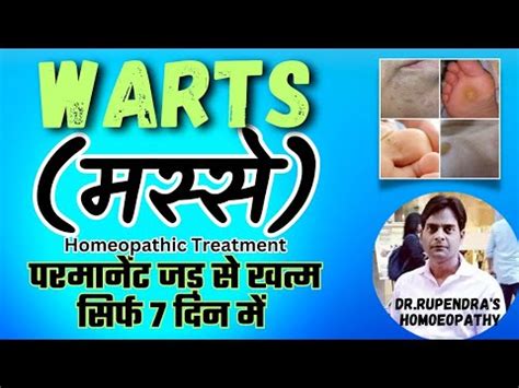 Warts Masse Warts Homeopathy Best Medicine Face Warts Homeopathic
