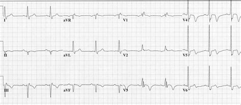 Wellens Syndrome Definition Diagnostic Criteria Causes Symptoms