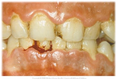 Perio Chap 8 Other Conditions Affecting The Periodontium Flashcards