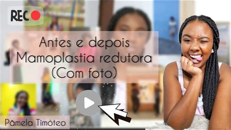 Antes e Depois Mamoplastia redutora Pâmela Timóteo YouTube