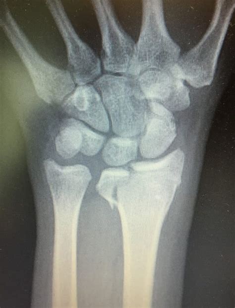 Distal Radius Fractures San Antonio TX Jackson Orthopaedics