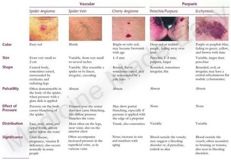 Petechiae Causes