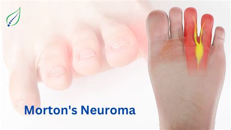Morton S Neuroma Causes Symptoms And Treatment Best Back Pain