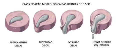 Abaulamento discal o que é tipos e tratamento Dr William Zarza