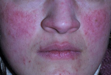 Lupus eritematoso sistémico Dermatopharm