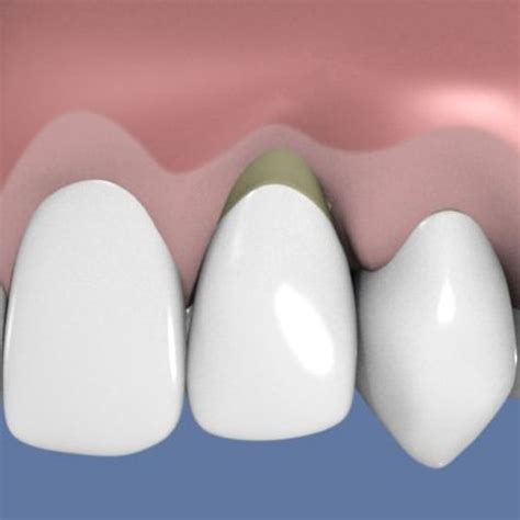 Traiter ou pas une récession gingivale I Dentiste Divonne