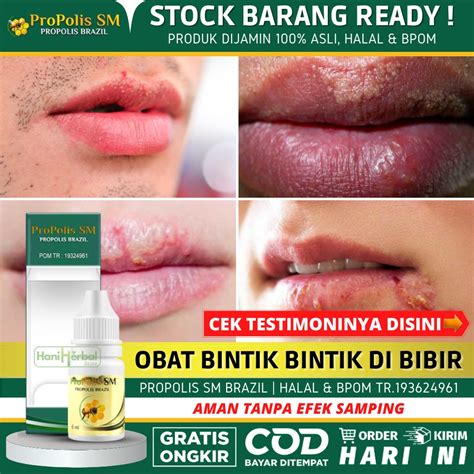 Jual Obat Bintik Bintik Putih Di Bibir Obat Oles Penghilang Bintik