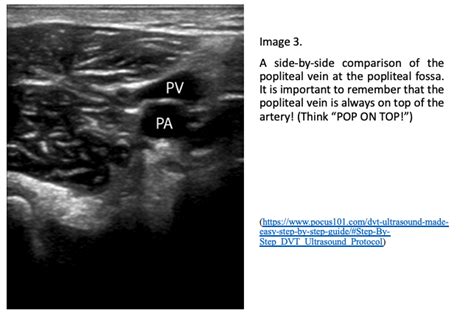 Deep Femoral Artery Ultrasound