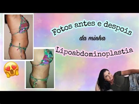 Lipoabdominoplastia Fotos De Antes E Depois 50 Dias YouTube