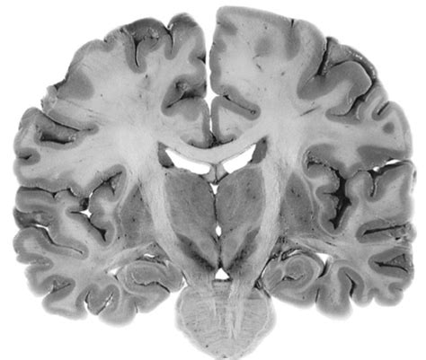 Brain Coronal Section Diagram Quizlet