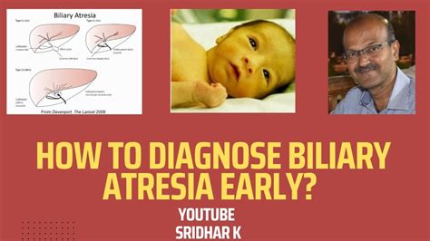 Biliary Atresia How To Diagnose Early Without Delay Biliaryatresia