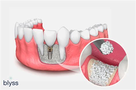 Bone Graft Surgery Dental Peridot Dental Care