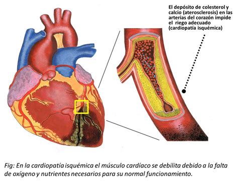 Insuficiencia Cardiaca CardiosaudeFerrol 40320 The Best Porn Website