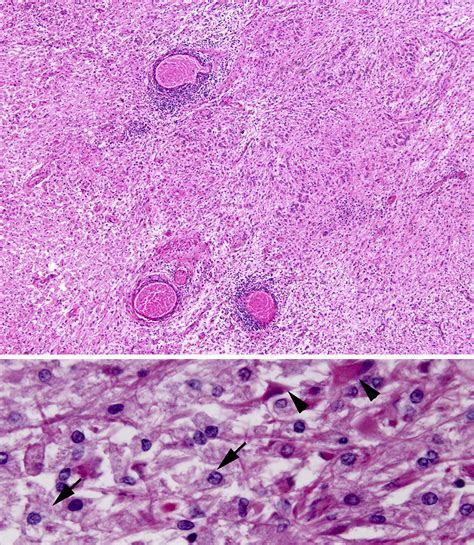 The Pathology Of Multiple Sclerosis And Related Disorders Diagnostic
