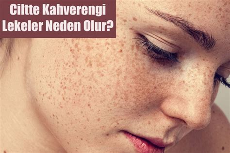Ciltte Kahverengi Lekeler Neden Olur