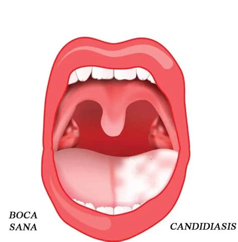 Candidiasis Oral Todo Sobre Esta Enfermedad Bucal Cl Nica Dental En