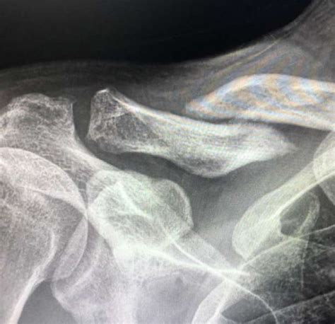 Fractura de Clavícula Dr Revenga Giertych Traumatólogo en Cádiz