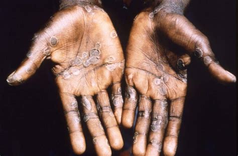 Monkeypox Vaiolo Delle Scimmie 5 Casi In Italia Informareonline