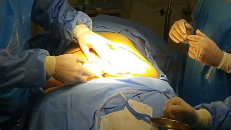 Abdominoplasty Incisonal Hernia Mesh Repair With Recti Plication Dr