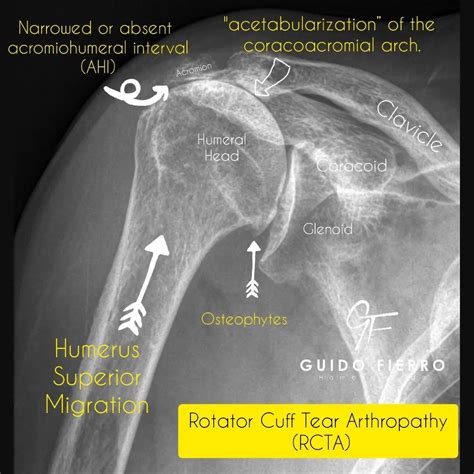 In 1977 Charles Neer And His Colleagues Invented The Term Cuff Tear