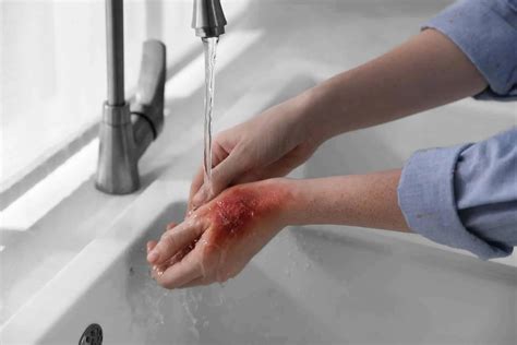 Burn Injury Lawyers Compare Our Ratings Results To Other Firms