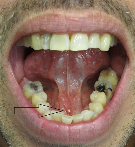 Blocked Salivary Glands In Lips Lipstutorial Org