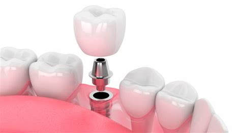 Implantes Dentales De Carga Inmediata En Tacna