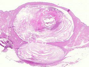 Patología del quiste epidermoide Hoogstra Centros Medicos