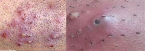 Ingrown Hair Bump On Vag Treatment Intoxicated Portal Picture Gallery