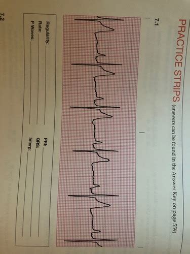 Ekg Strips Flashcards Quizlet