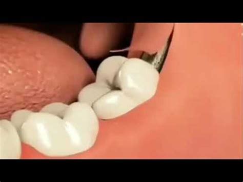 VEJA COMO É FEITA A EXTRAÇÃO DE UM DENTE SISO YouTube