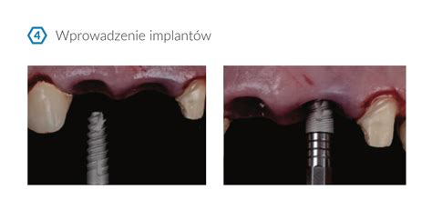 Natychmiastowa implantacja z natychmiastowym obciążeniem w strefie