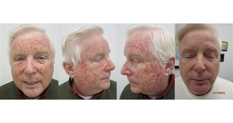 Efudex Treatment Face Doctor Heck