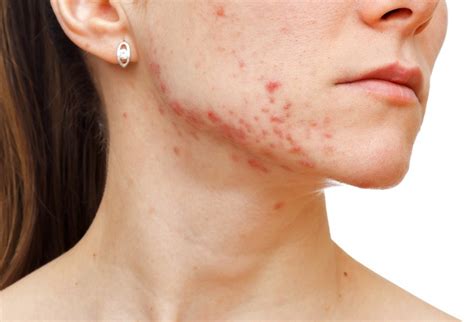 Acne da mulher Adulta Marco Rocha Dermatologia São Paulo