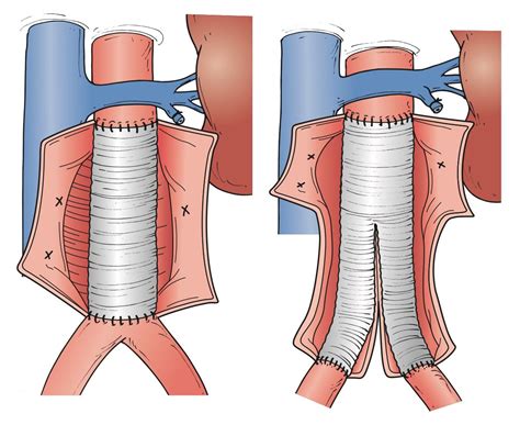 Aneurisma Aorta Abdominal Dr Lucien Chassin Trubert