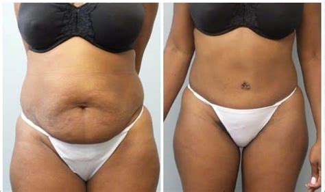 Peut On Se Baigner Apr S Une Abdominoplastie Les News Du Web Par
