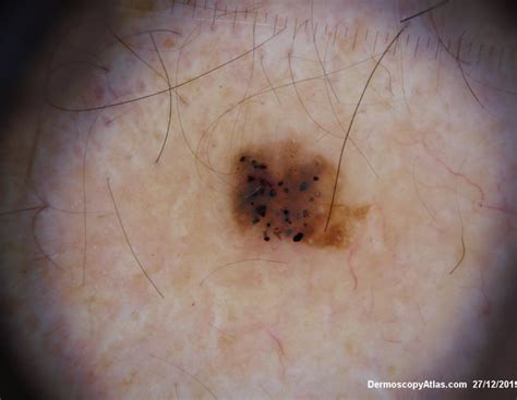 Seborrheic Keratosis Dermoscopy